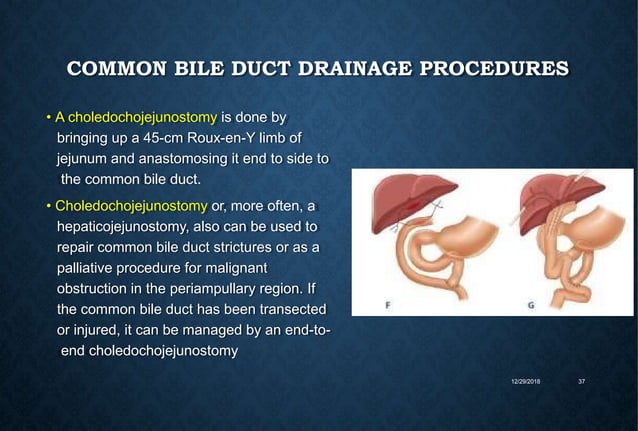 CBD STONE , etiology presentation and management | PPTX | Digestive Disorders | Diseases and ...