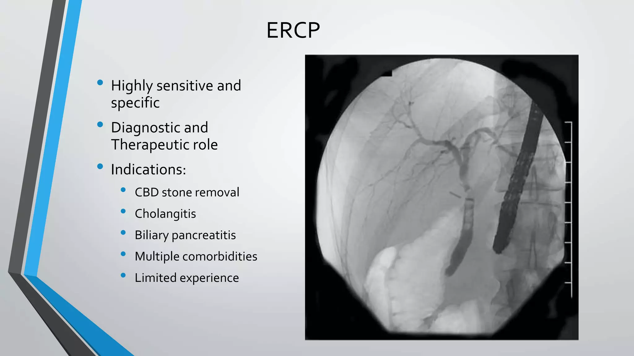 CBD stones/ Choledocholithiais / Biliary stones | PPTX