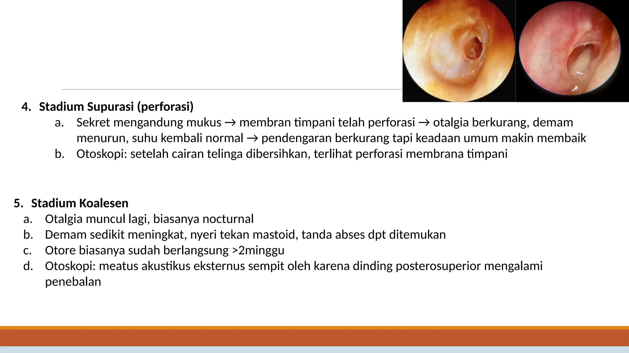 Case based discussion otitis media akut case | PPTX