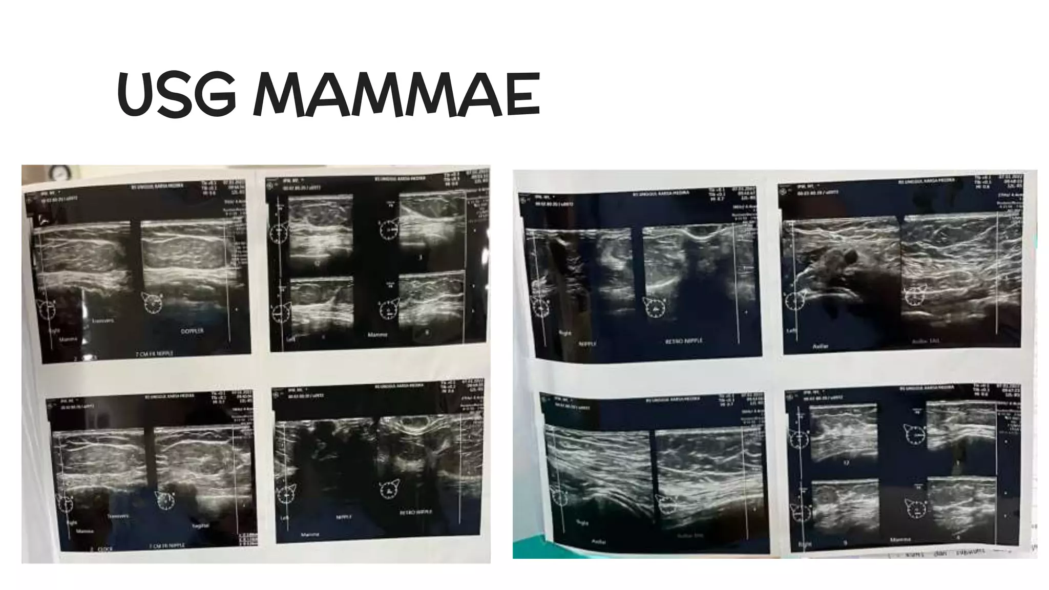 TUMOR JINAK MAMMAE | PPTX