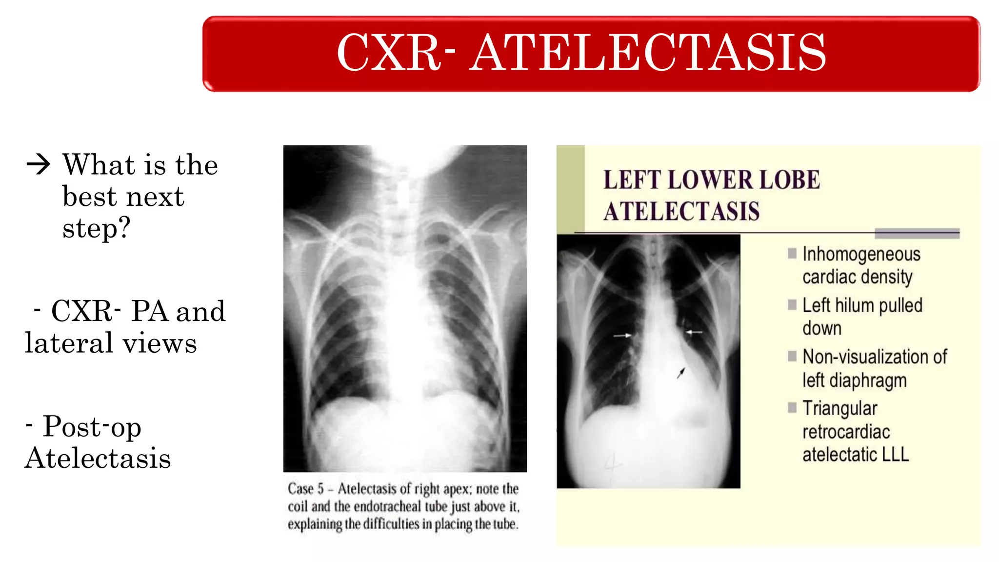 POST-OPERATIVE FEVER ON POD#1- Case based learning | PPTX