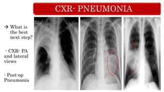 POST-OPERATIVE FEVER ON POD#1- Case based learning | PPTX