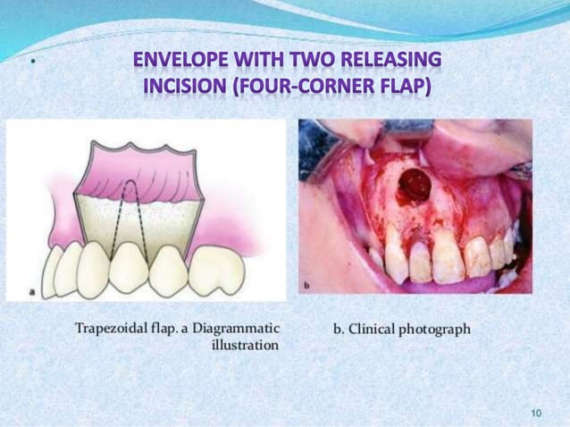 CBL ORAL SUGERY TYPES OF FLAP USED IN OS | PPTX