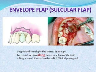 CBL ORAL SUGERY TYPES OF FLAP USED IN OS | PPTX