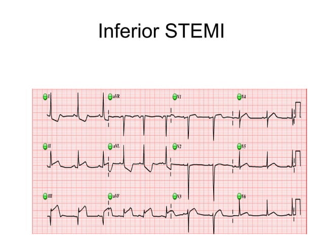 EKG Lead aVr | PPT | Heart and Cardiovascular Diseases | Diseases and ...