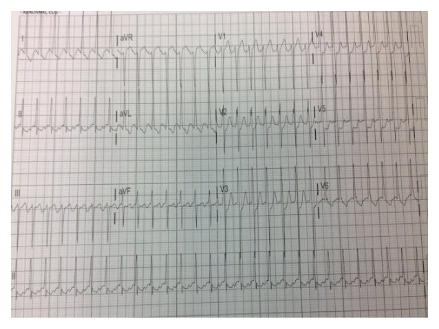EKG Lead aVr
