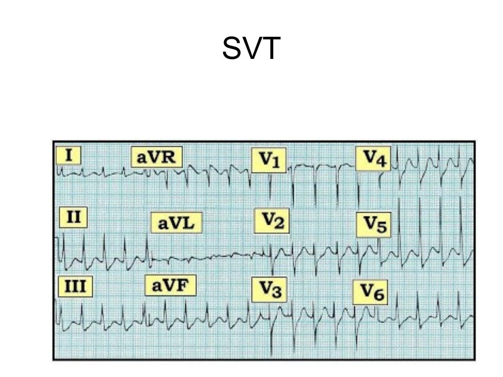 EKG Lead aVr