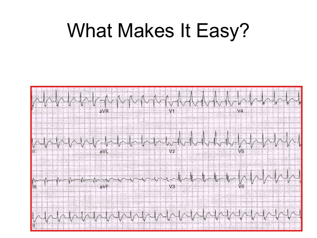 EKG Lead aVr
