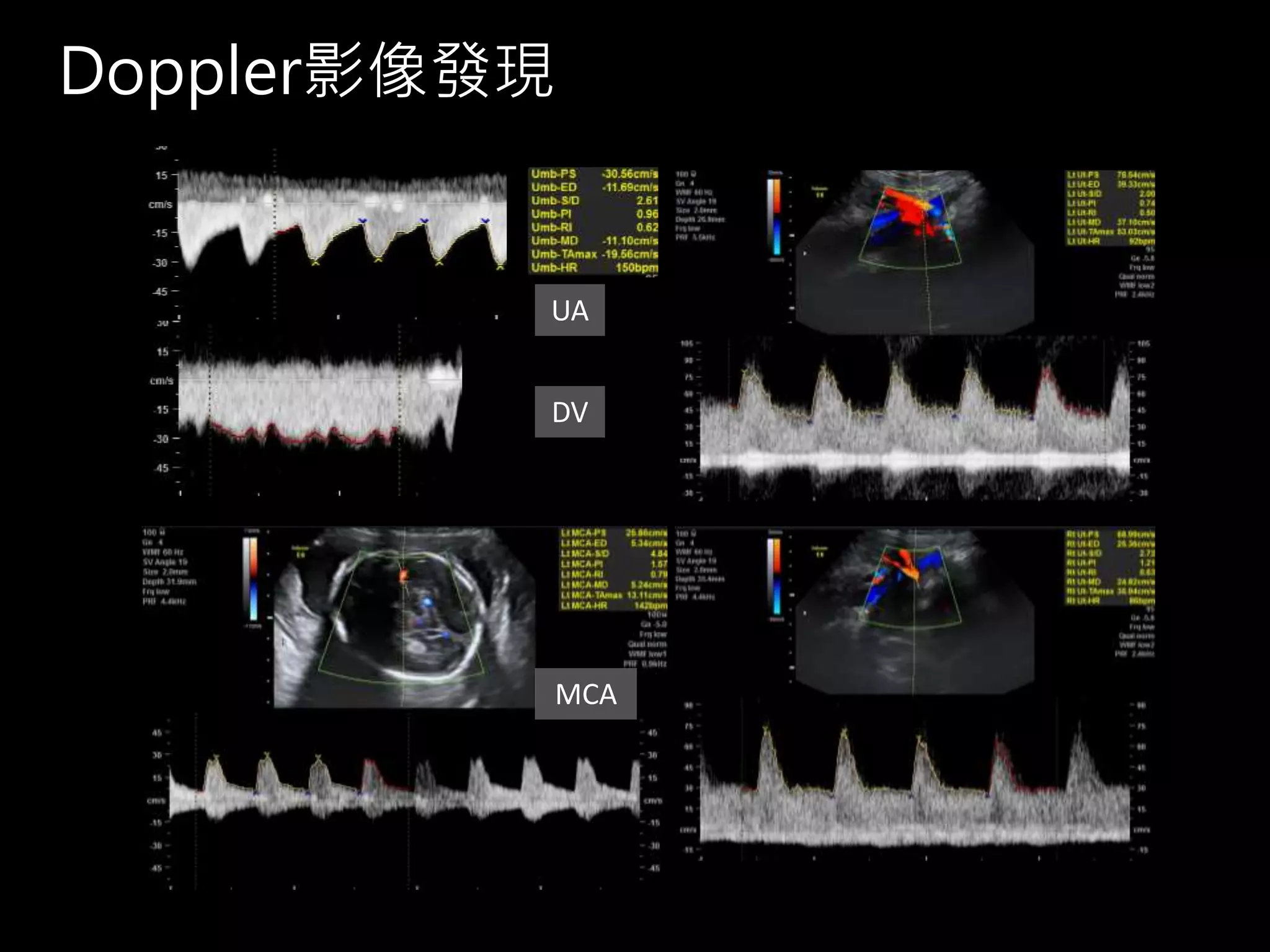 CCAM Congenital Cystic Adenomatoid Malformation | PPTX