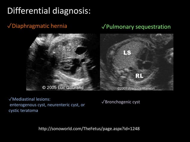 CCAM Congenital Cystic Adenomatoid Malformation | PPTX