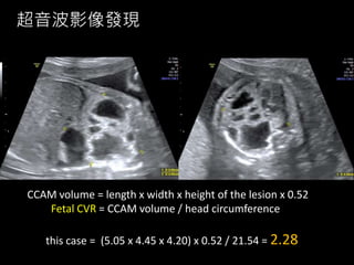 CCAM Congenital Cystic Adenomatoid Malformation | PPTX