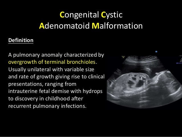 CCAM Congenital Cystic Adenomatoid Malformation