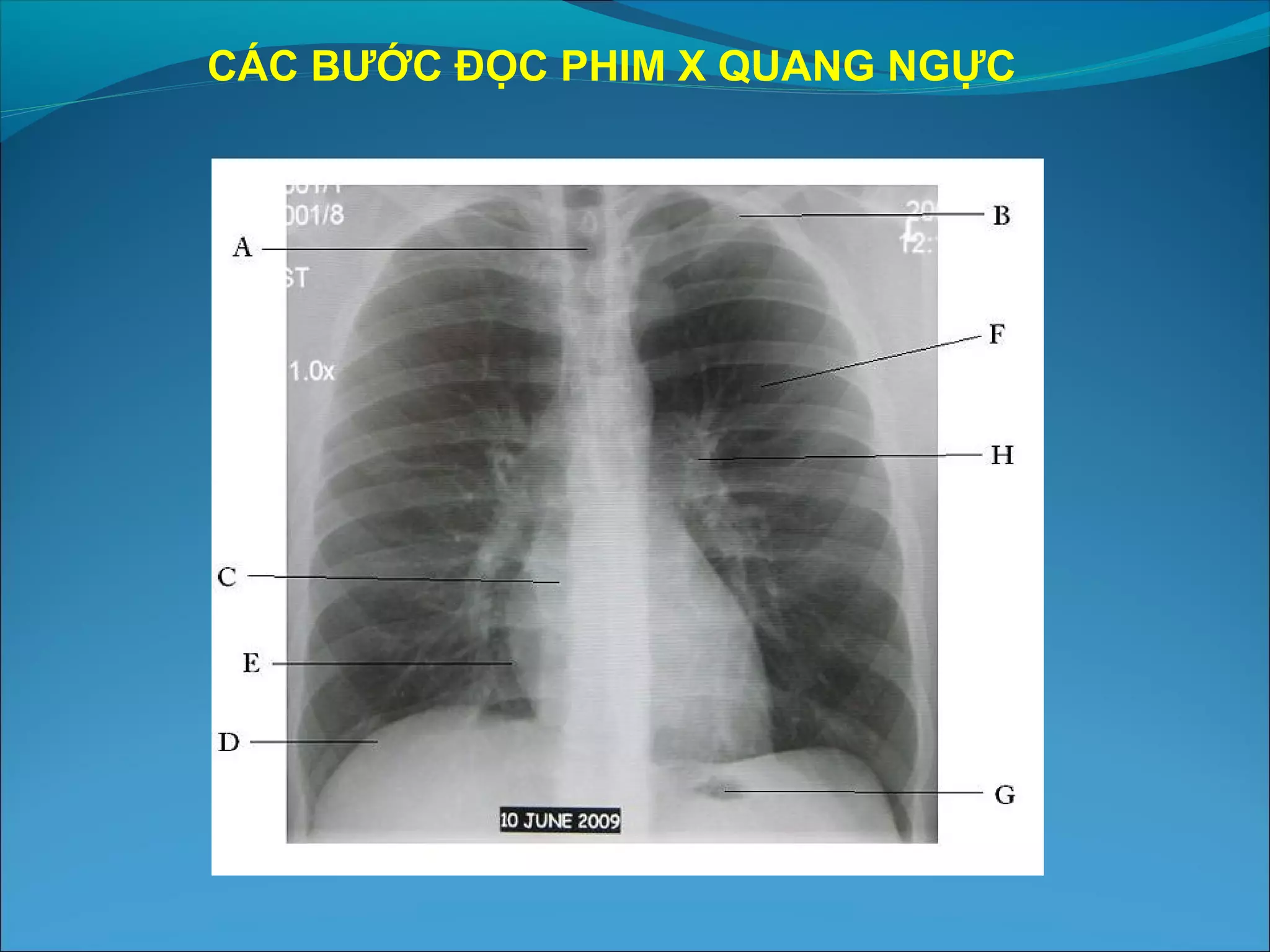 Các bước đọc phim x quang ngực bvtn | PPT