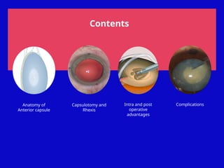 Contiunous Curvilinear Capsulorhexis .pptx