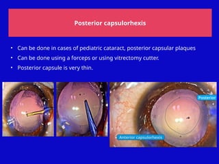 Contiunous Curvilinear Capsulorhexis .pptx