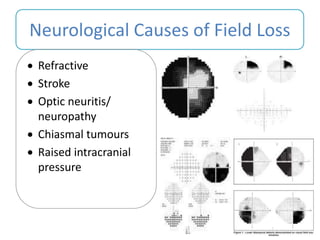 Interpreting Visual Fields | PPTX