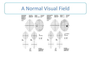 Interpreting Visual Fields | PPTX