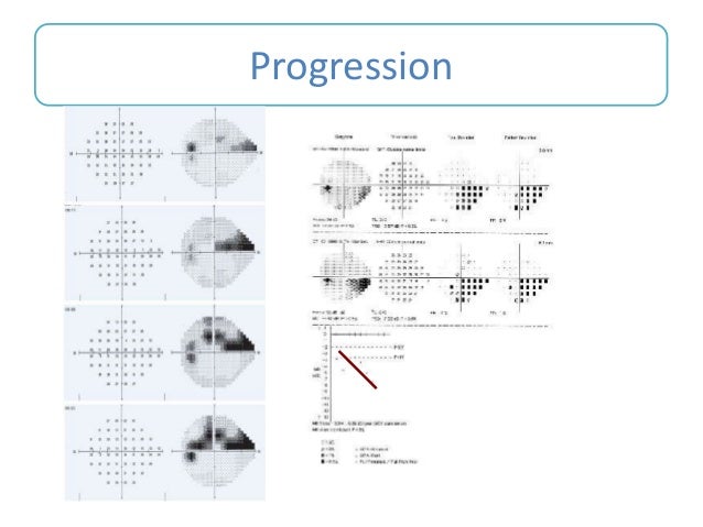 Interpreting Visual Fields