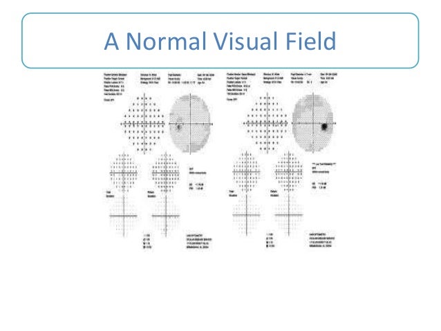 Interpreting Visual Fields Interpreting Visual Fields