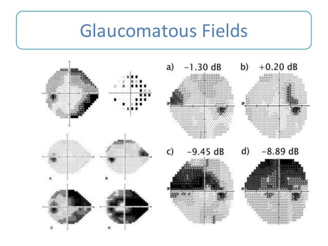 Interpreting Visual Fields