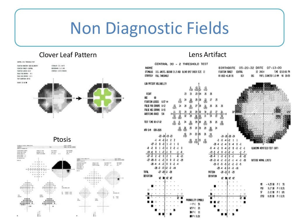 Interpreting Visual Fields