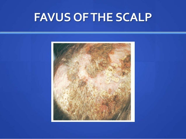 Pilomicozele – Dermatofiţii ale pielii păroase – NewsMed.ro