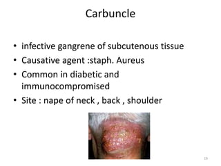 soft tissue infection | PPTX