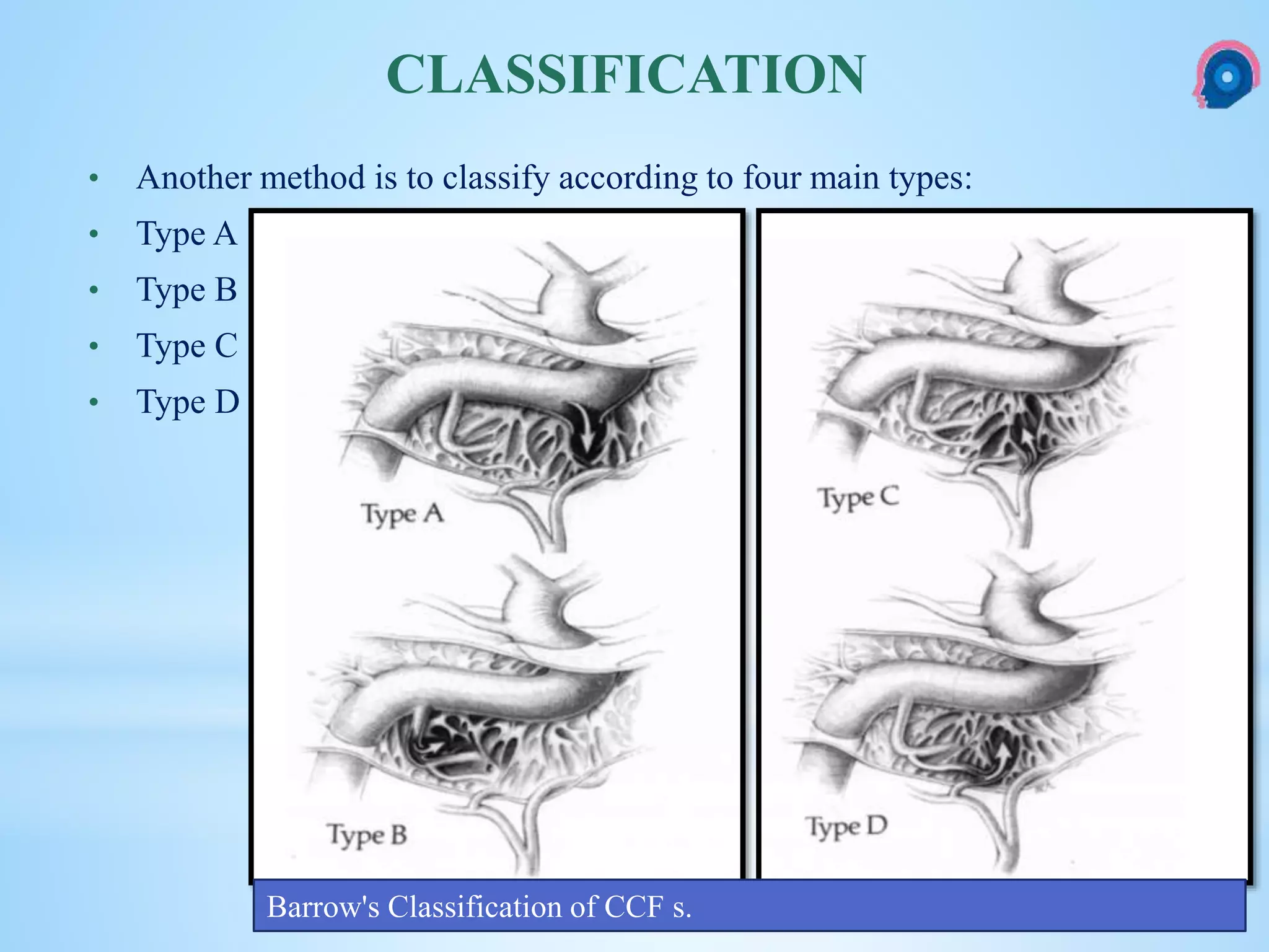 Caroticocavernous fistula CCF | PPTX