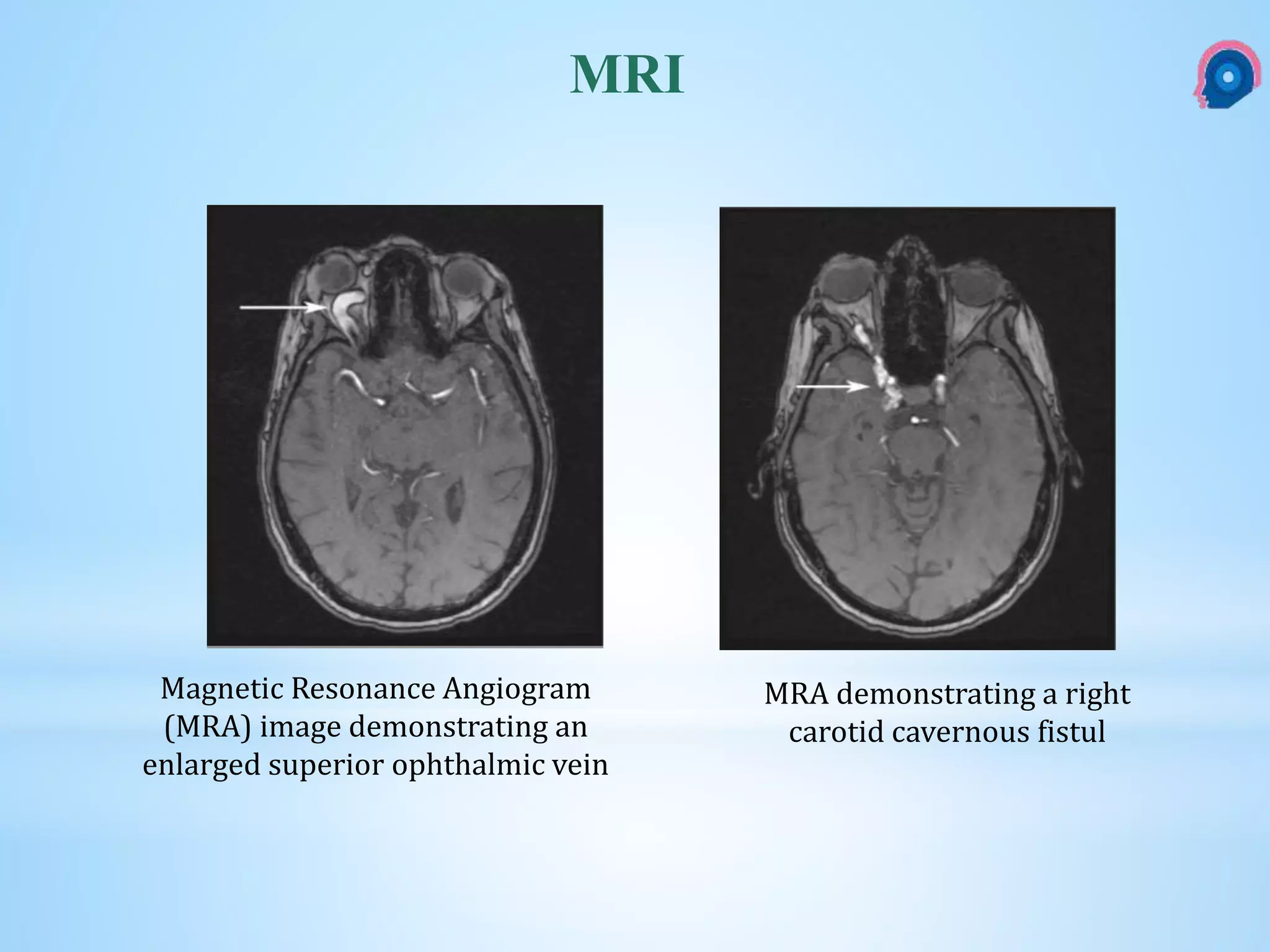 Caroticocavernous fistula CCF | PPTX