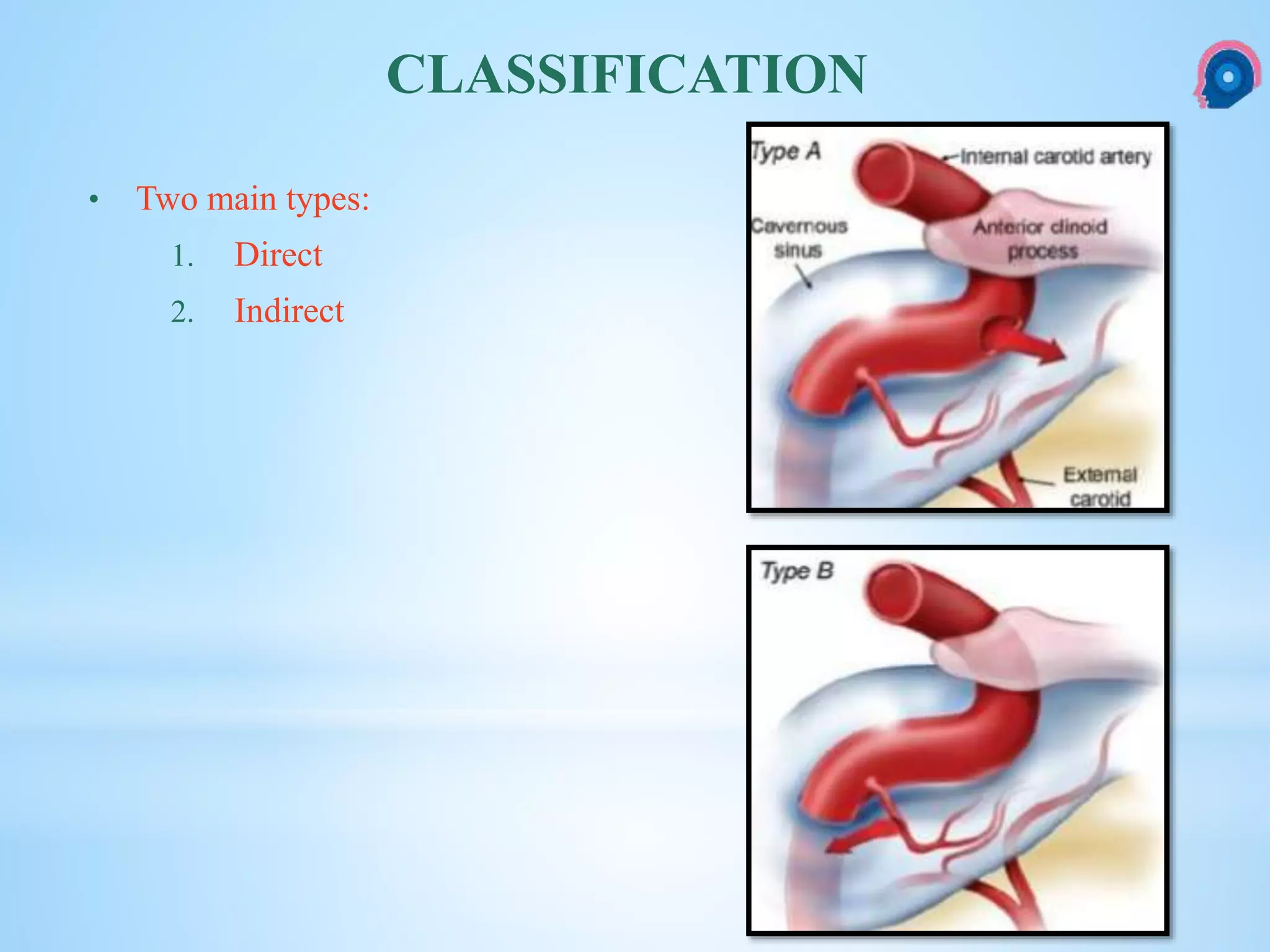 Caroticocavernous fistula CCF | PPTX