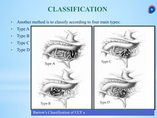 Caroticocavernous fistula CCF | PPTX