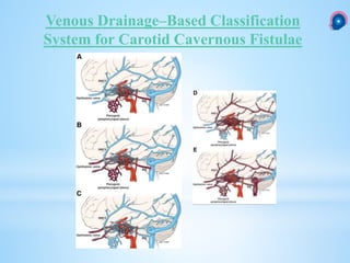 Caroticocavernous fistula CCF | PPTX