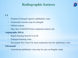 Caroticocavernous fistula CCF | PPTX