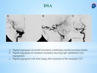 Caroticocavernous fistula CCF | PPTX