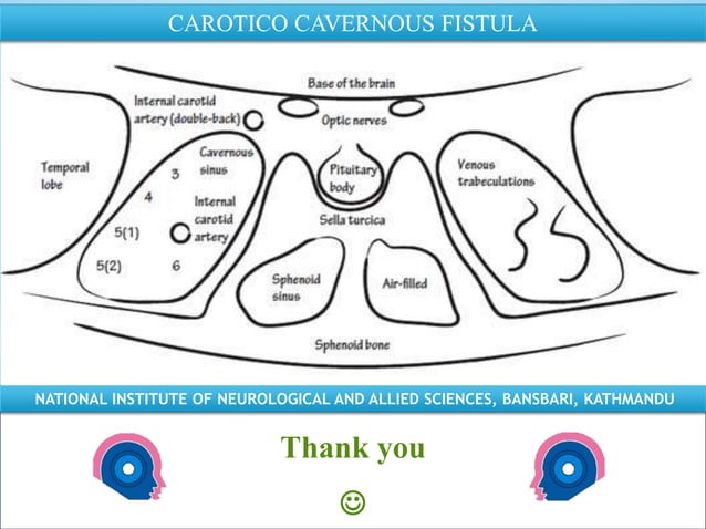 Caroticocavernous fistula CCF | PPTX