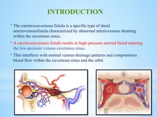 Cavernous Sinus Fistula