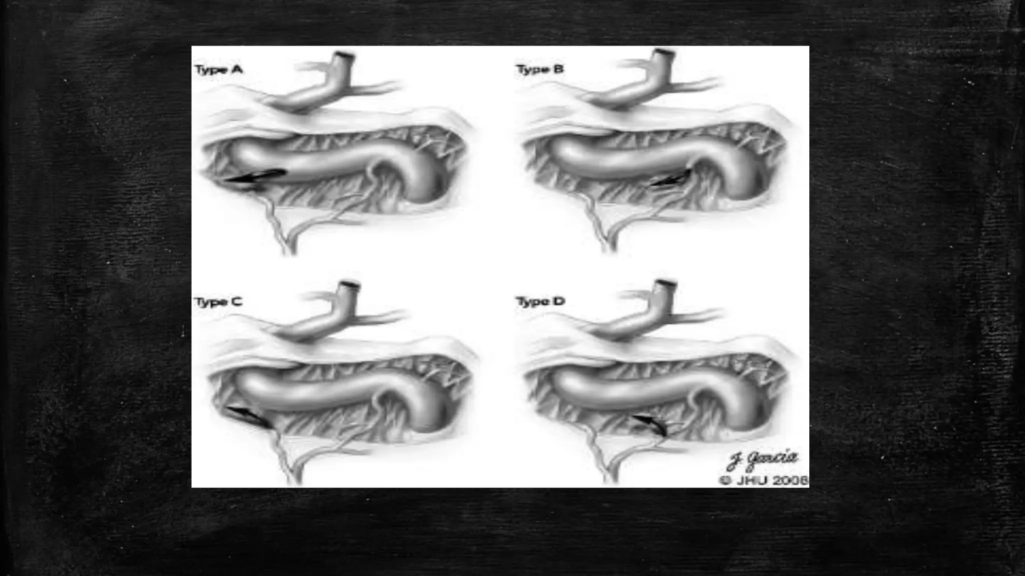 Carotid cavernous fistula | PPTX