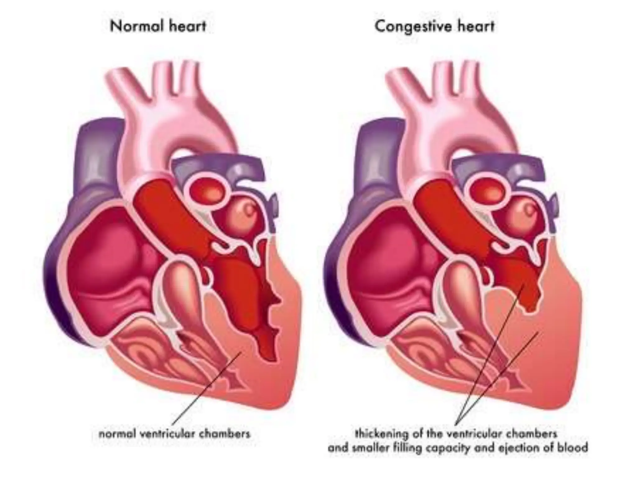 CCF cardiac nursing including pathophysiology and nursing diagnosis | PPTX