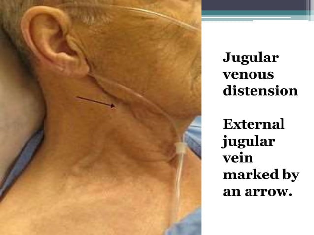 CCF cardiac nursing including pathophysiology and nursing diagnosis ...