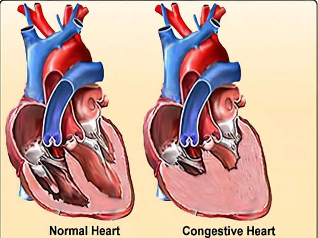 CCF cardiac nursing including pathophysiology and nursing diagnosis | PPT
