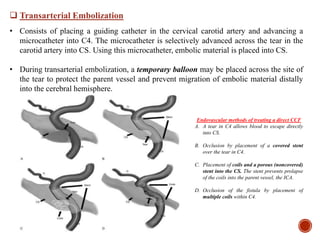 TRAUMATIC CCF | PPTX