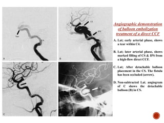 TRAUMATIC CCF | PPTX