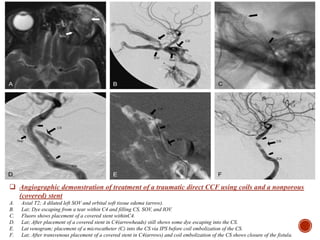 TRAUMATIC CCF | PPTX