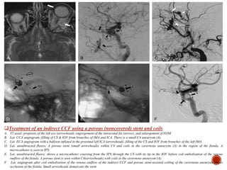 TRAUMATIC CCF | PPTX