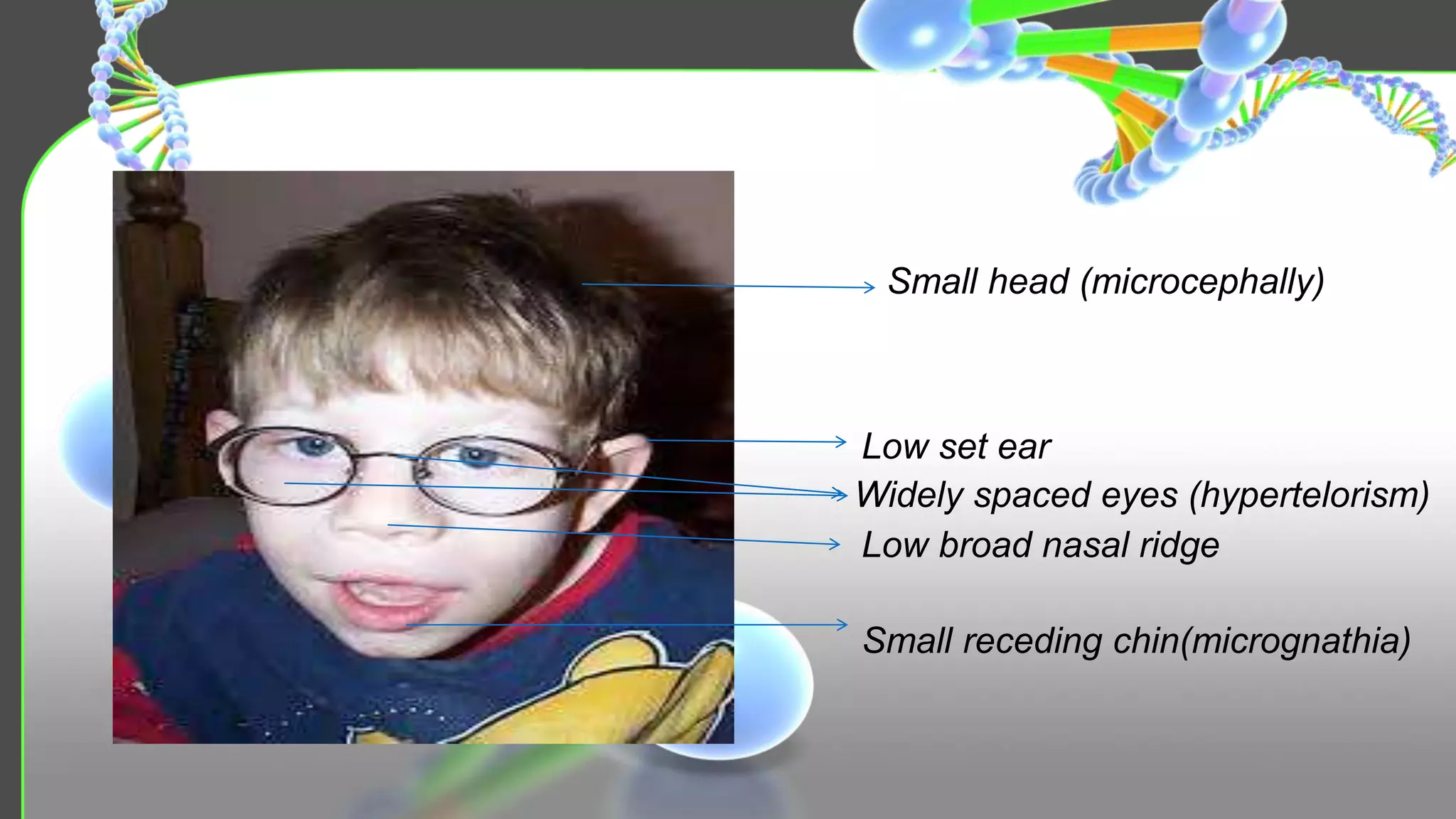 Cri du chat syndrome, | PPTX