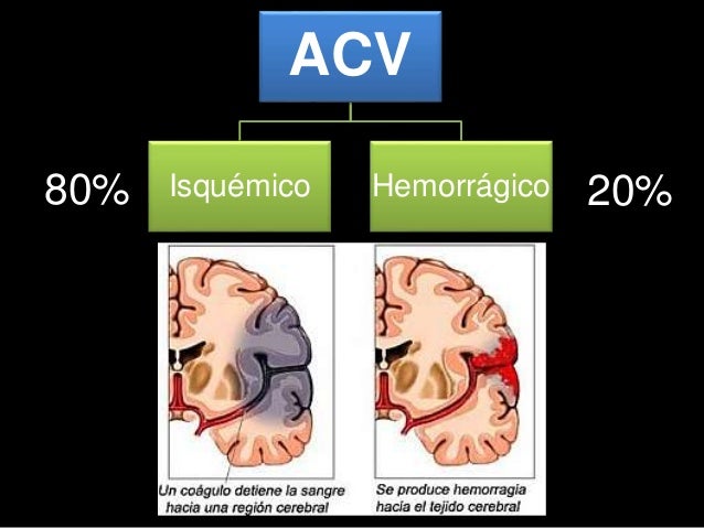 ACV isquémico