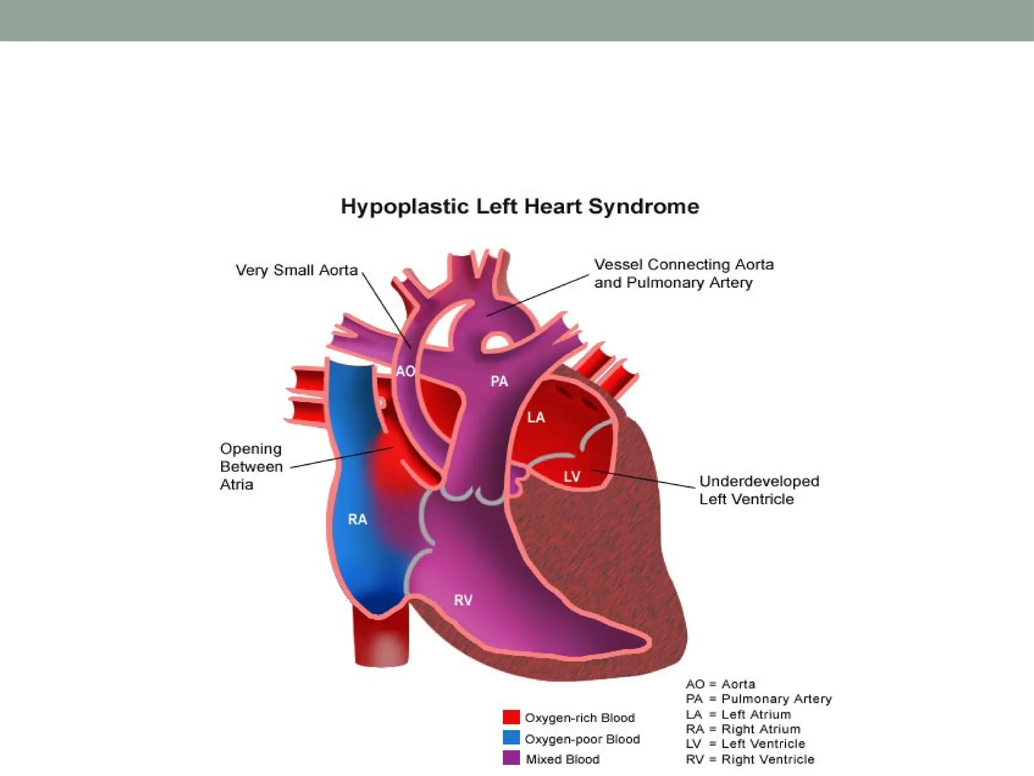 Cyanotic congenital heart diseases in Pediatrics | PPTX