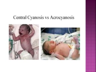 Acrocyanosis Vs Cyanosis