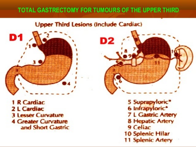 Current Concept of Management Gastric Carcinoma