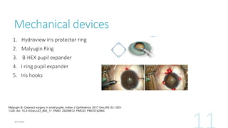 Complex cases in Cataract surgery and its management.pptx